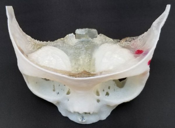 Dermoid Cyst - DASH 3D